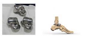 Custom talus implant - Jajal Medical Service
