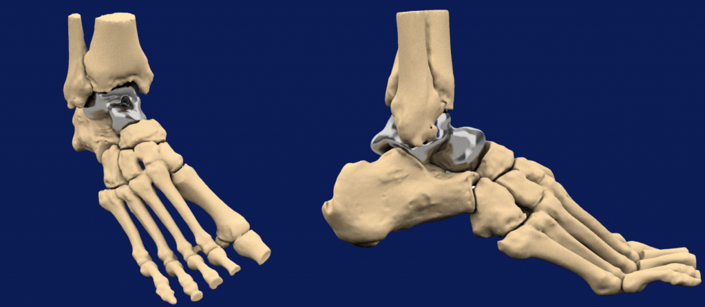 Custom talus implant - Jajal Medical Service