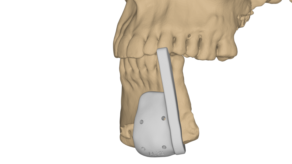 Custom TMJ Implant - Jajal Medical Service