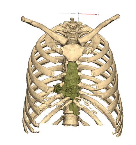 Custom Sternum Implant