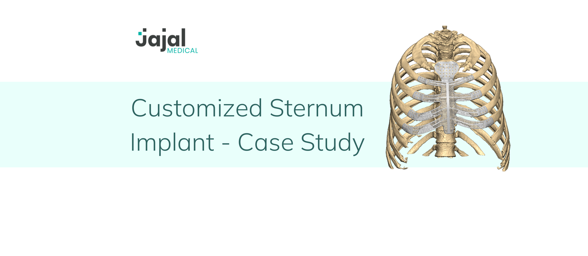 Custom Sternum Implant