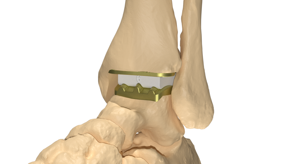 InJoint- Customized Total Ankle replacement - Jajal Medical Service