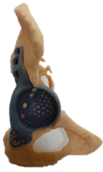 Custom Revision Hip Biflange implant. - Jajal Medical Service