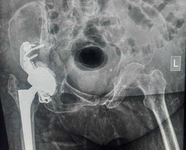 Custom Revision Hip Cage implant. - Jajal Medical Service