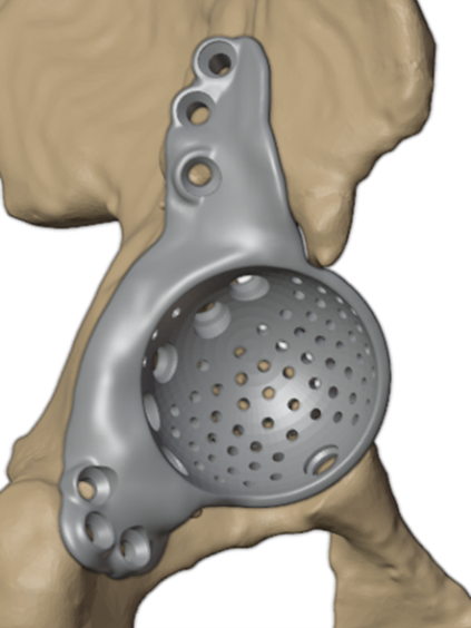 Custom Revision Hip Biflange implant. - Jajal Medical Service