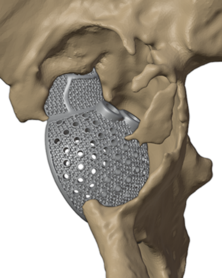Custom Revision Hip Biflange implant. - Jajal Medical Service