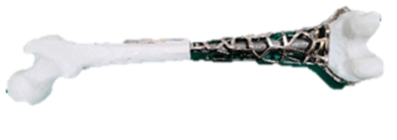 Distal Femur Replacement - Jajal Medical Service