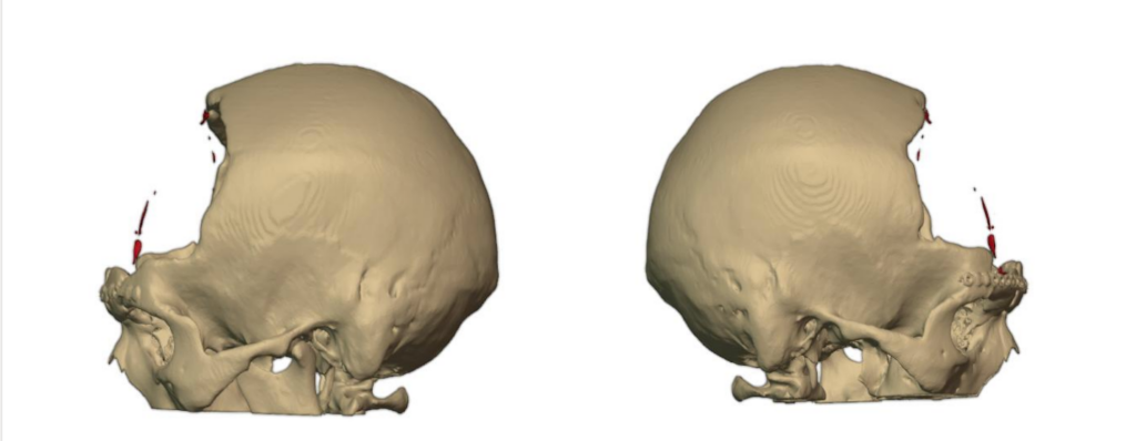Precision Reconstruction in Frontal Defect with Customized PMMA Cranial ...