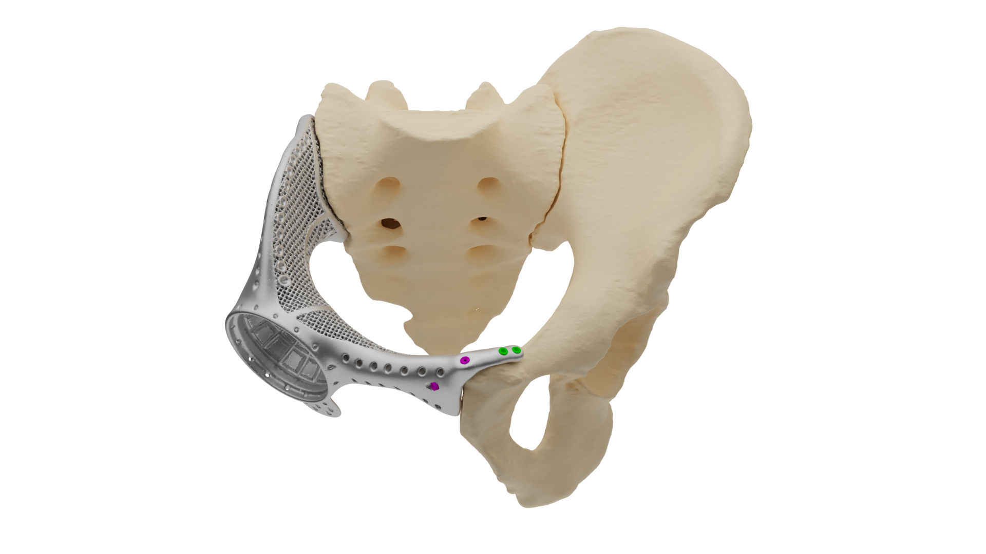 Reconstruction of Right Hemipelvis with a Customized Implant Solution ...