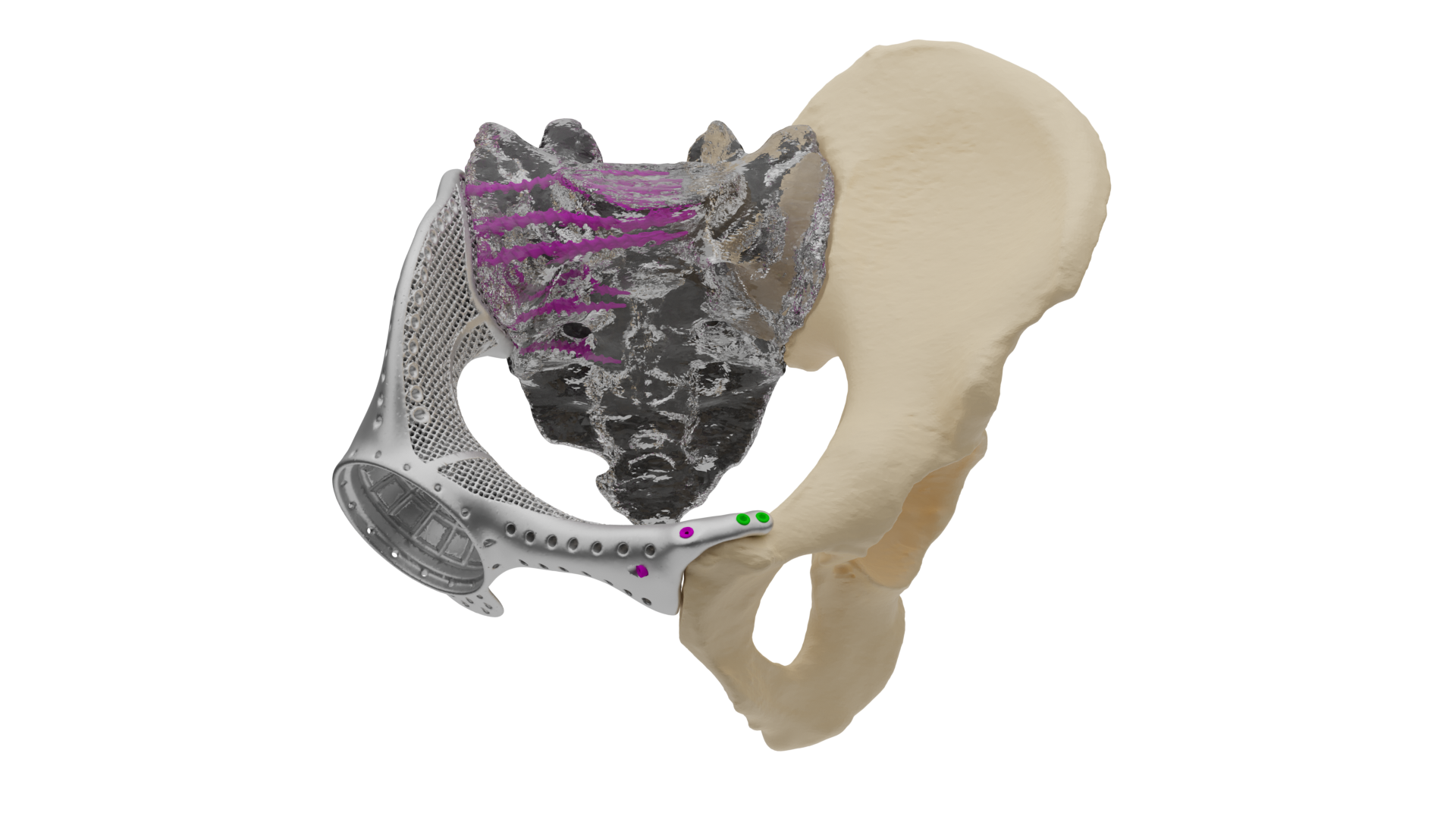 Reconstruction of Right Hemipelvis with a Customized Implant Solution ...